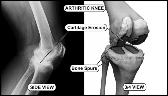 ~ Arthritic Hips & Knees Images – Hip and Knee Handbook of Joint ...